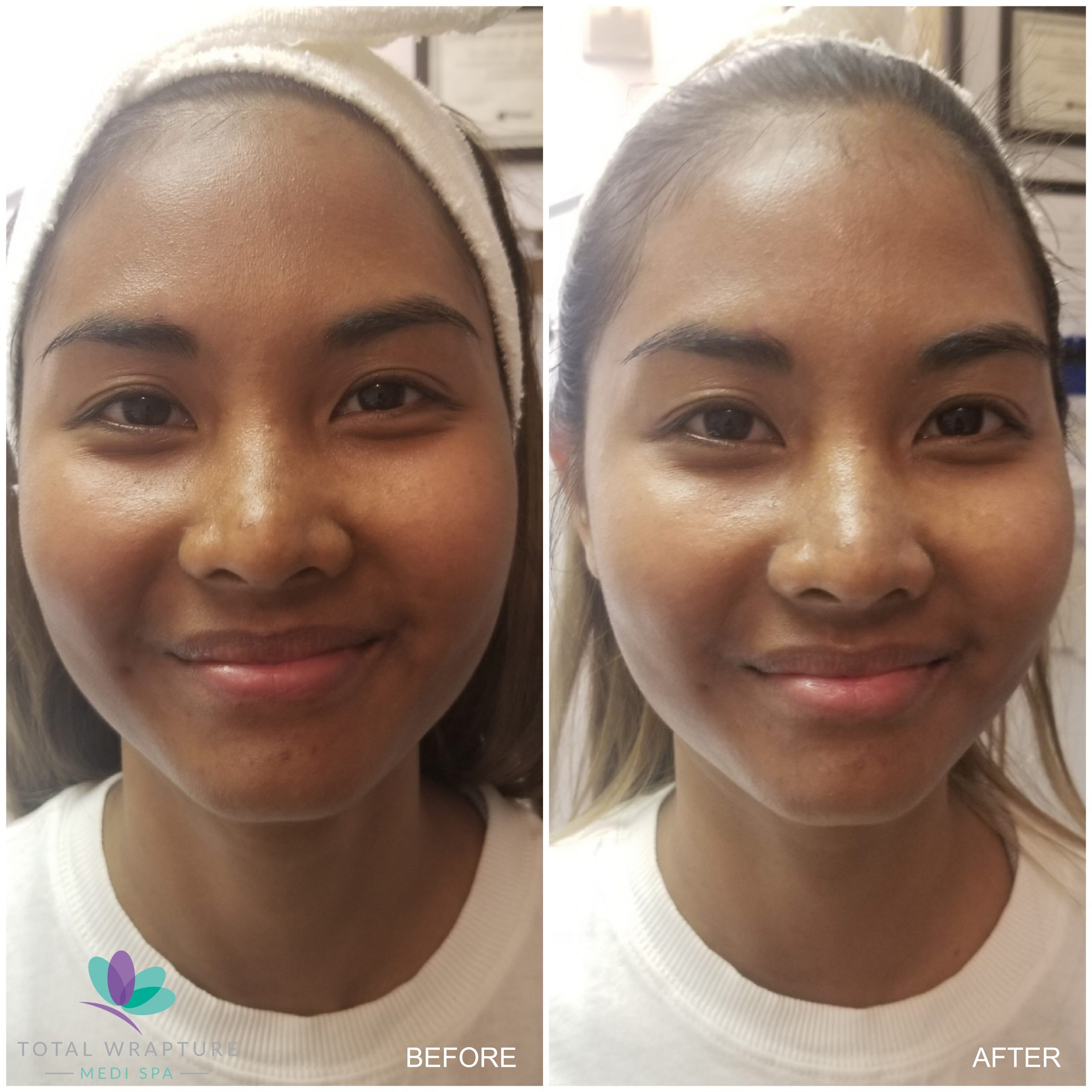 Needleless Mesotherapy | Winnipeg | Total Wrapture Medi Spa