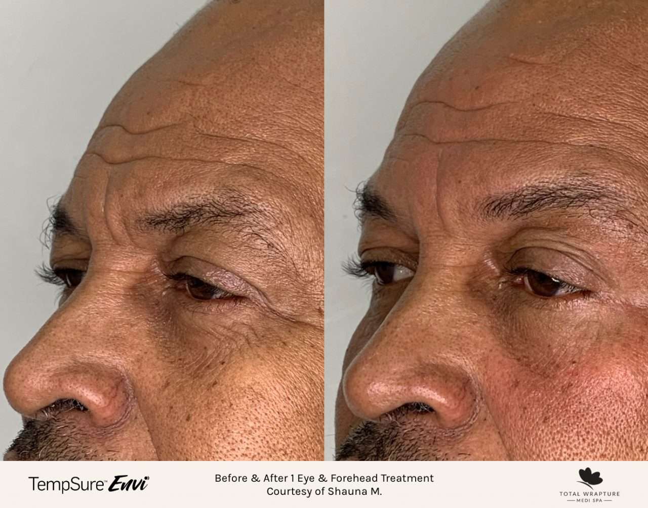 Should I try RF Skin Tightening? – Total Wrapture Medi Spa