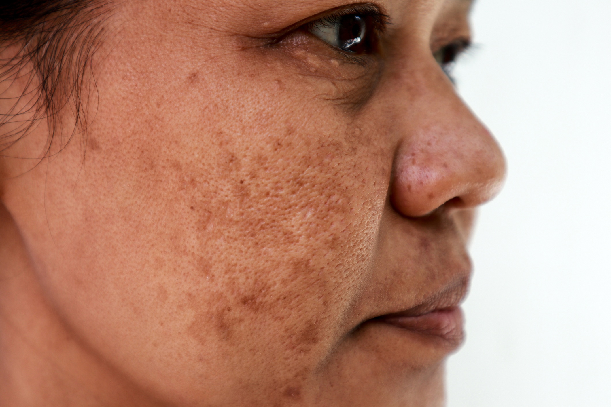 Melasma and Laser Treatments: What You Should Know
