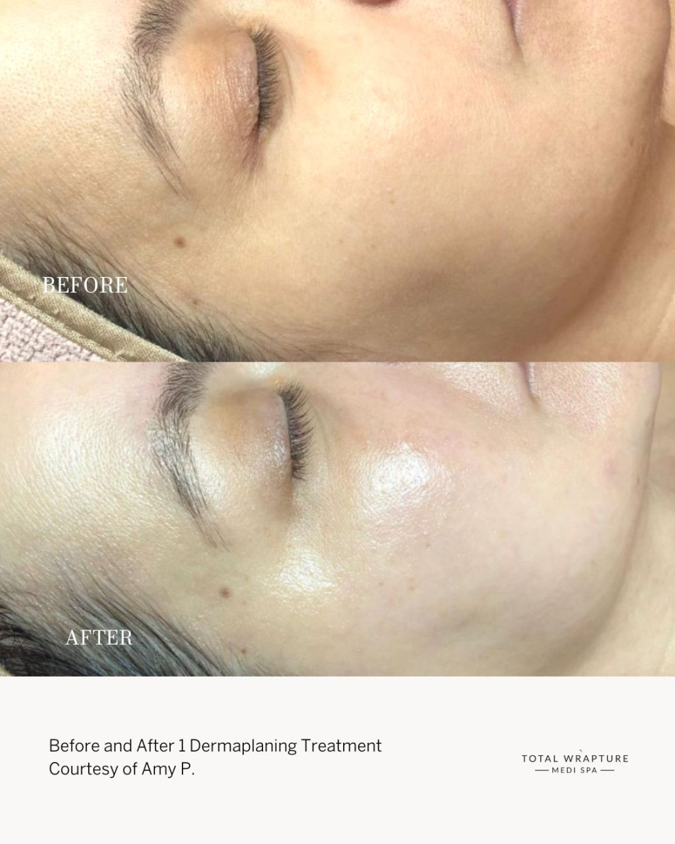 Why Dermaplaning in Winnipeg is on the Rise – Total Wrapture Medi Spa