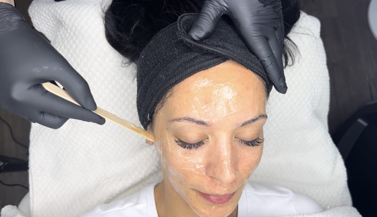 My Experience Getting a Skin Resurfacing Laser Treatment – Total ...