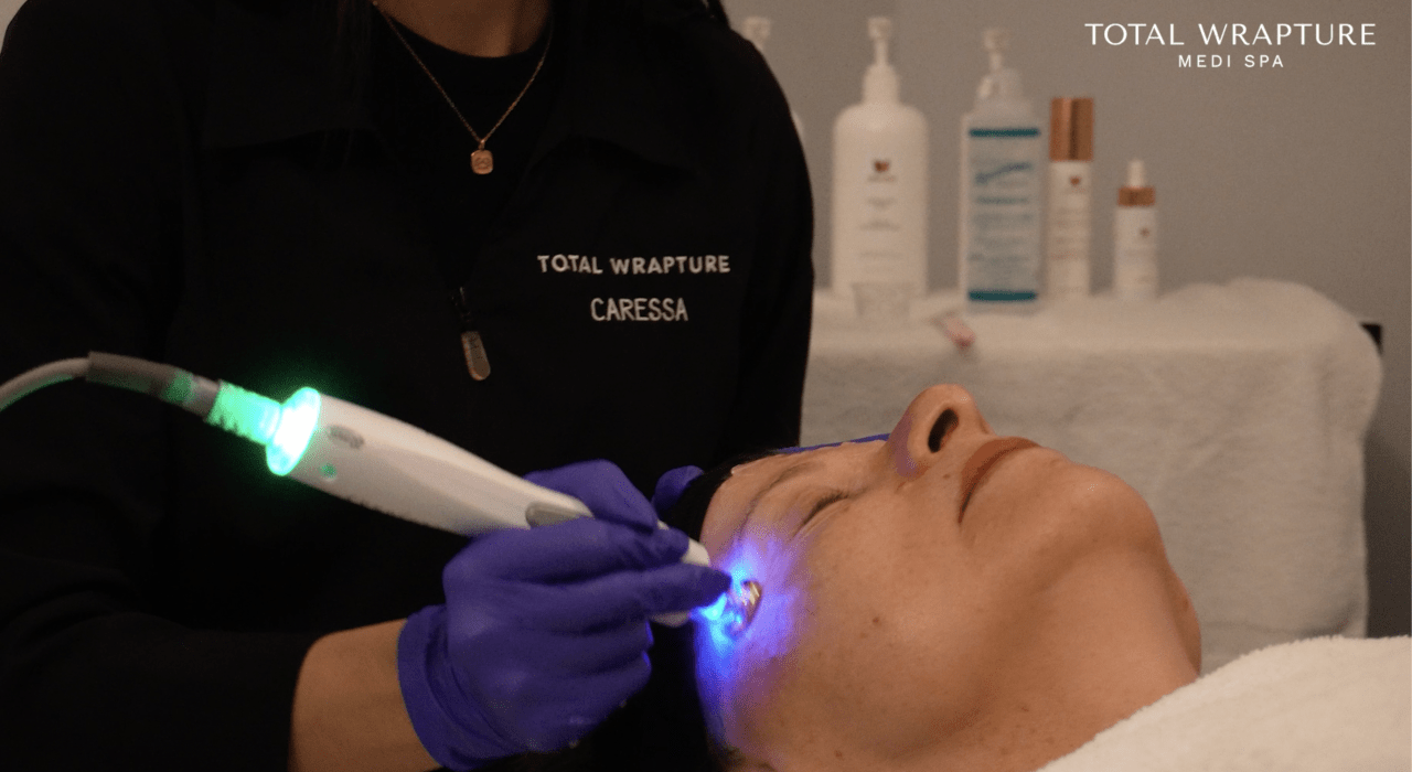 Jacquie's Experience with Skin Tightening – Total Wrapture Medi Spa