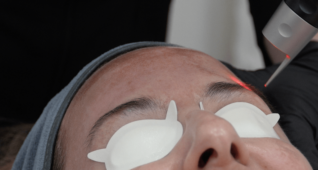 What Laser Treatments Make You Look Younger? – Total Wrapture Medi Spa