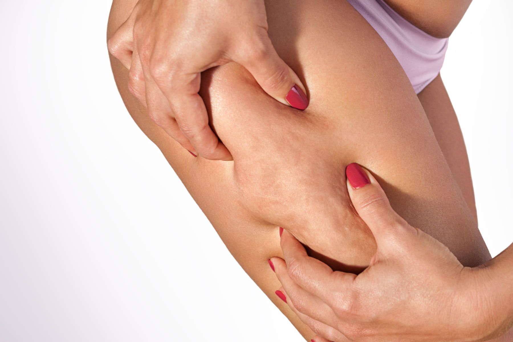 How to Get Rid of Cellulite: Your Complete Guide – Total Wrapture Medi Spa